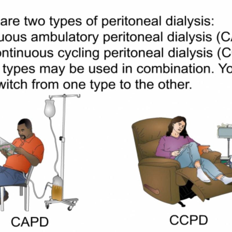 Continuous Cycling Peritoneal Dialysis (CCPD): Enhanced Efficiency in ...